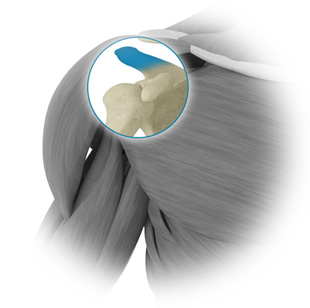 Clinique chirurgicale de Laval | Épaule | Acromioplastie par arthroscopie