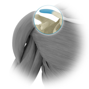 Clinique Chirurgicale de Laval | Shoulder | Acromioclavicular repair